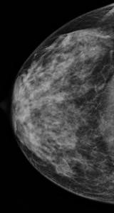 Mammographie 3D tomosynthèse - Radiologie Levallois